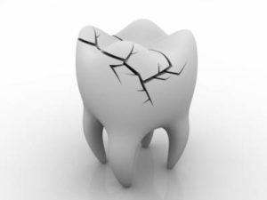 Cracked Molar Repair Procedure | UtoDent.com