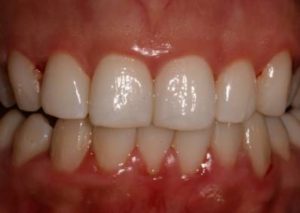 Causes of Swollen Gums and How to Get Rid of It | UtoDent.com