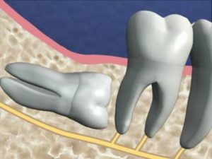 Impacted Teeth: Symptoms and Treatment | UtoDent.com