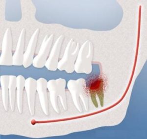 Infected Wisdom Tooth: Causes, Signs, Treatment | UtoDent.com