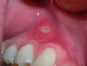 Blisters on Gums Above Tooth - Oral Health