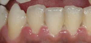 Acute Necrotizing Ulcerative Gingivitis: Causes, Signs and Treatment
