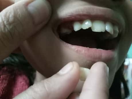 Molar Teeth Removal - What You Should Know