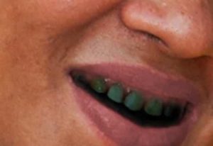 Tooth Turning Black - Causes, Signs and Treatment Options - Oral Health