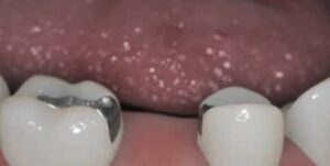 Back Tooth Fell Out: Causes and What to Do - Oral Health