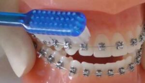 Teeth Wobbling Under Braces - Oral Health