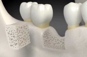 Bone Grafting in Dentistry - Oral Health