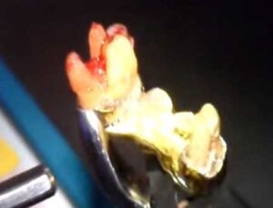 Tooth Cysts: Treat or Remove? - Oral Health