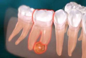 Tooth Root Cyst: What It Is and How Dangerous - Oral Health