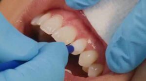 Restoring Tooth Enamel at Home - Oral Health